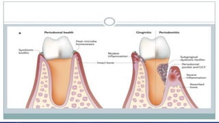 Periodontal pathogenesis affecting periodontal health.pptx