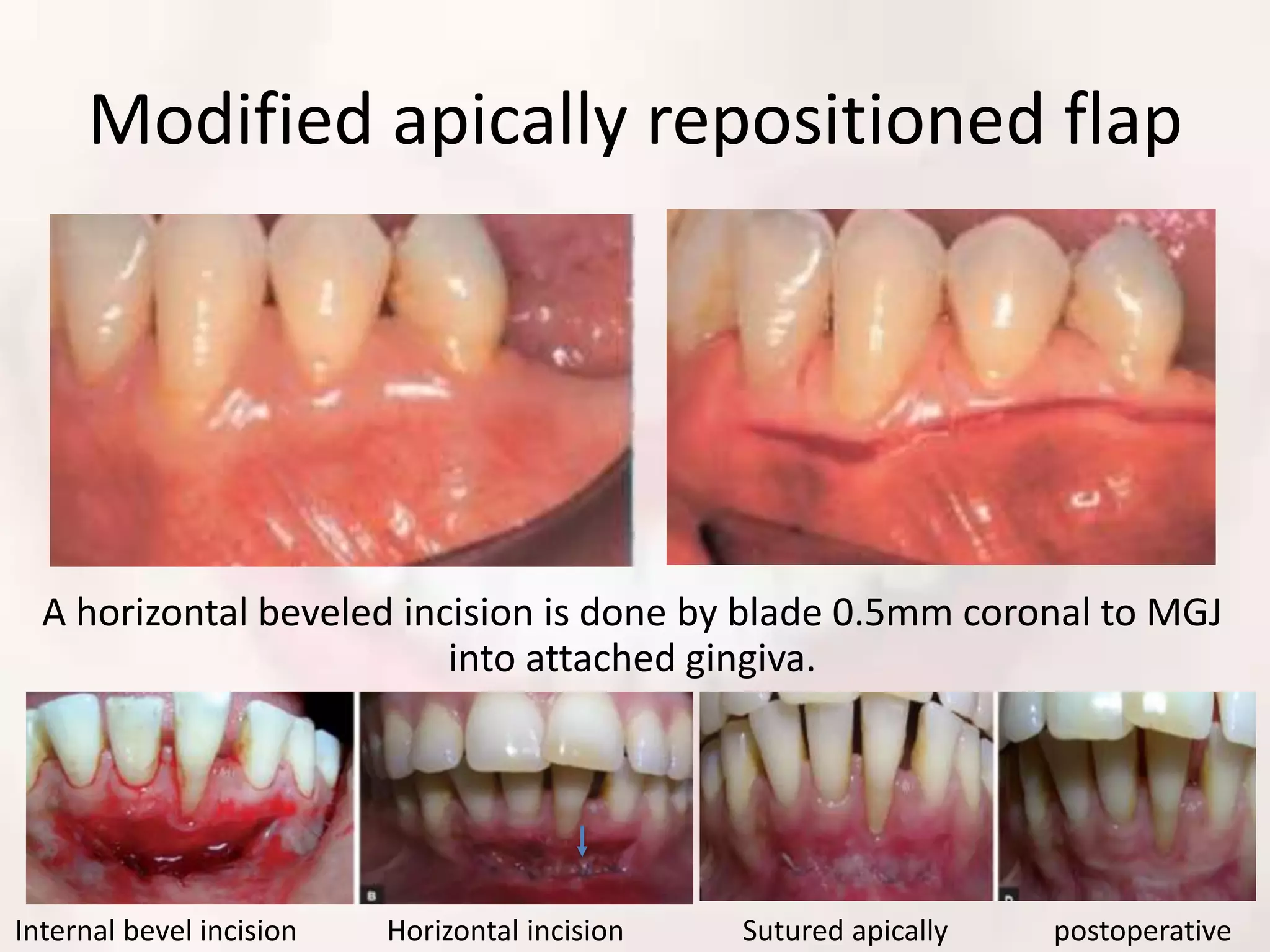 Periodontal plastic and esthetic surgery | PPTX