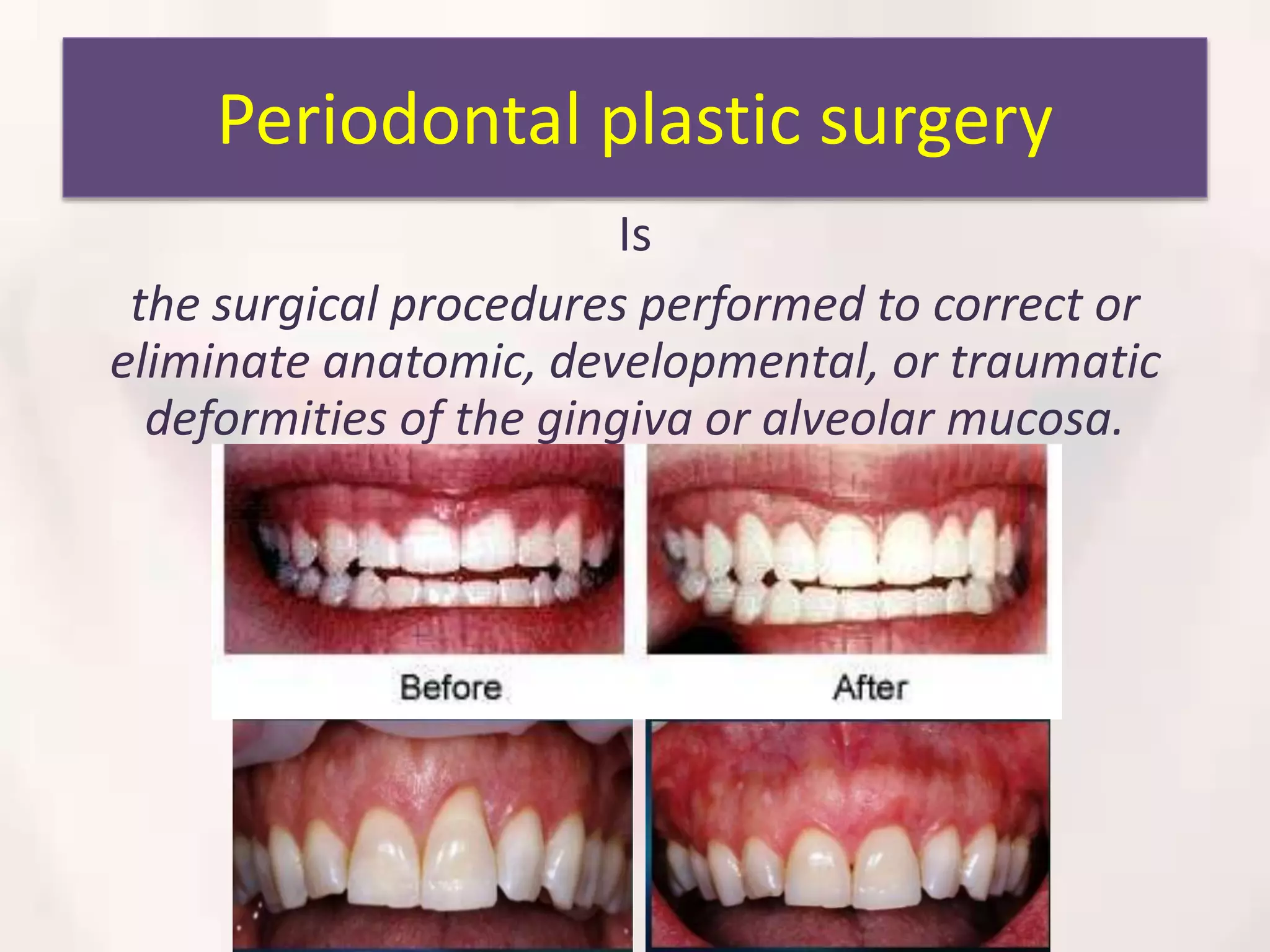 Periodontal plastic and esthetic surgery | PPTX