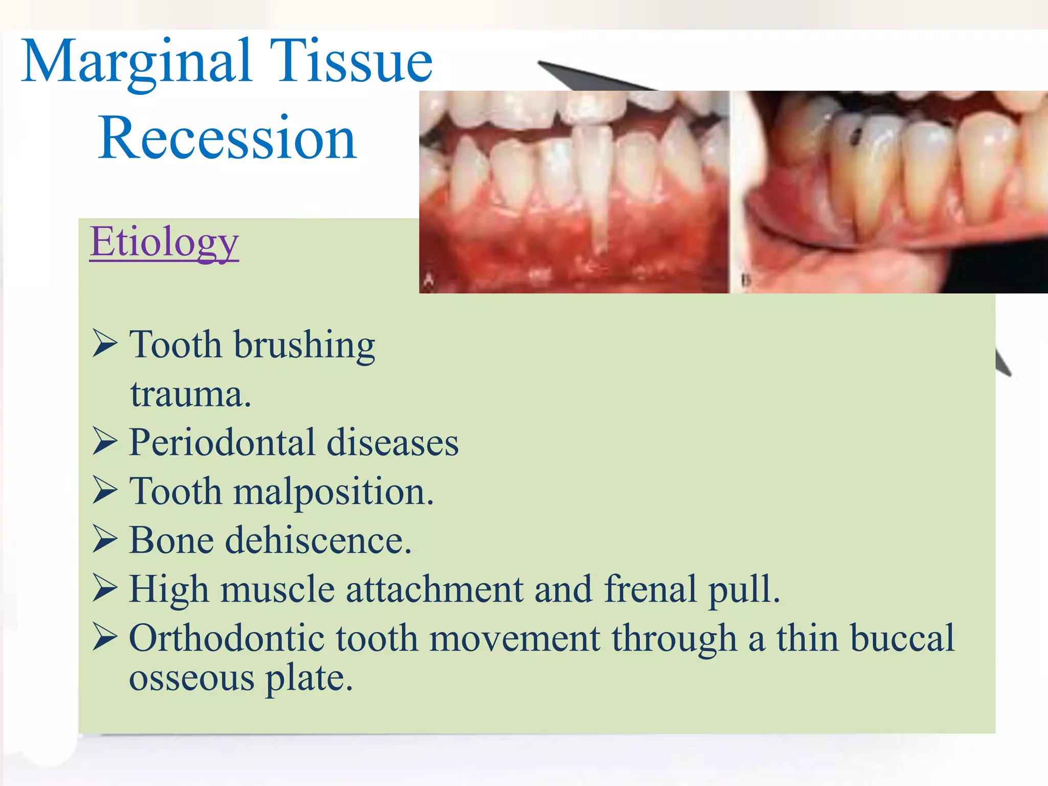 Periodontal plastic and esthetic surgery | PPTX