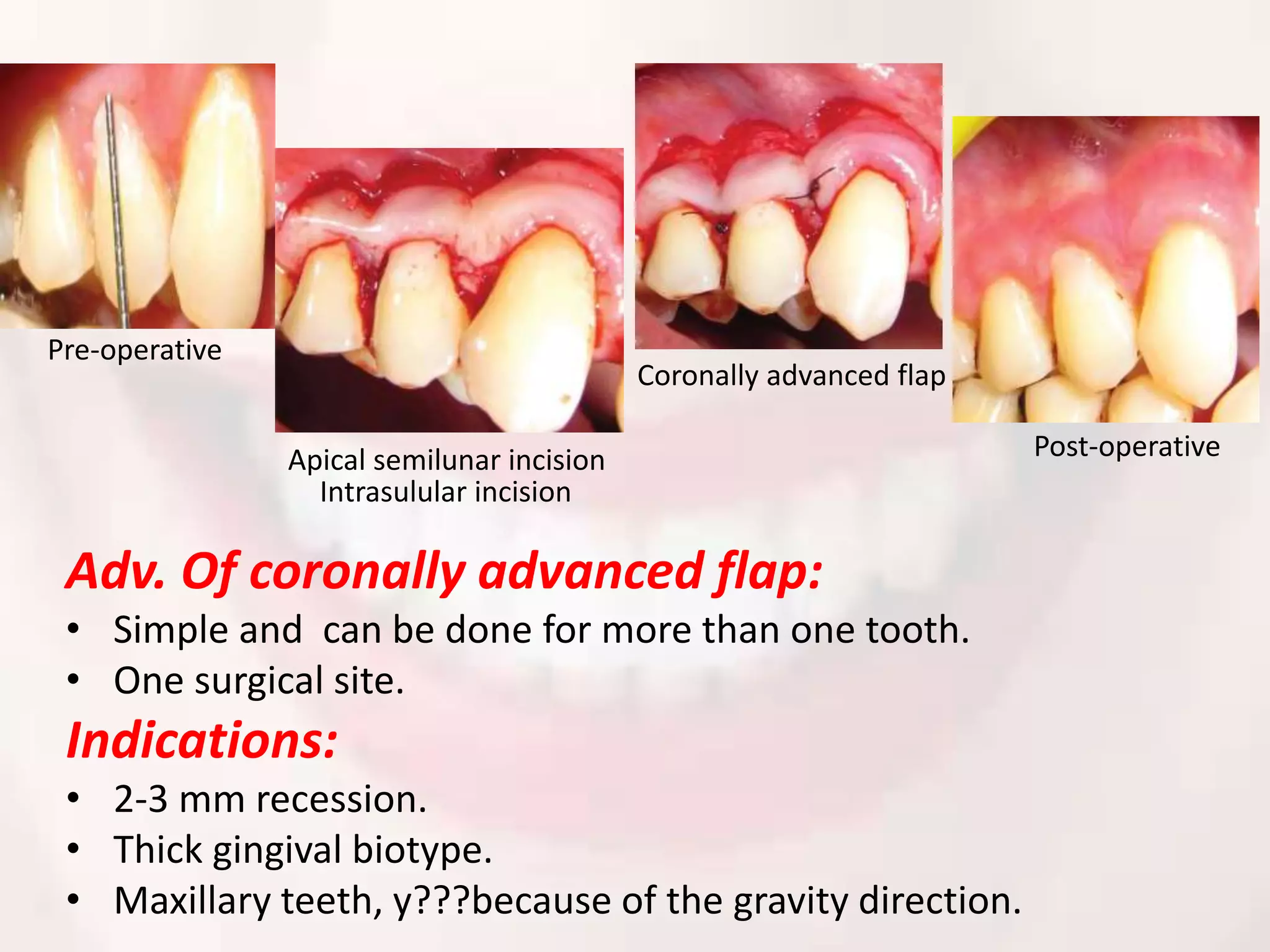 Periodontal plastic and esthetic surgery | PPTX