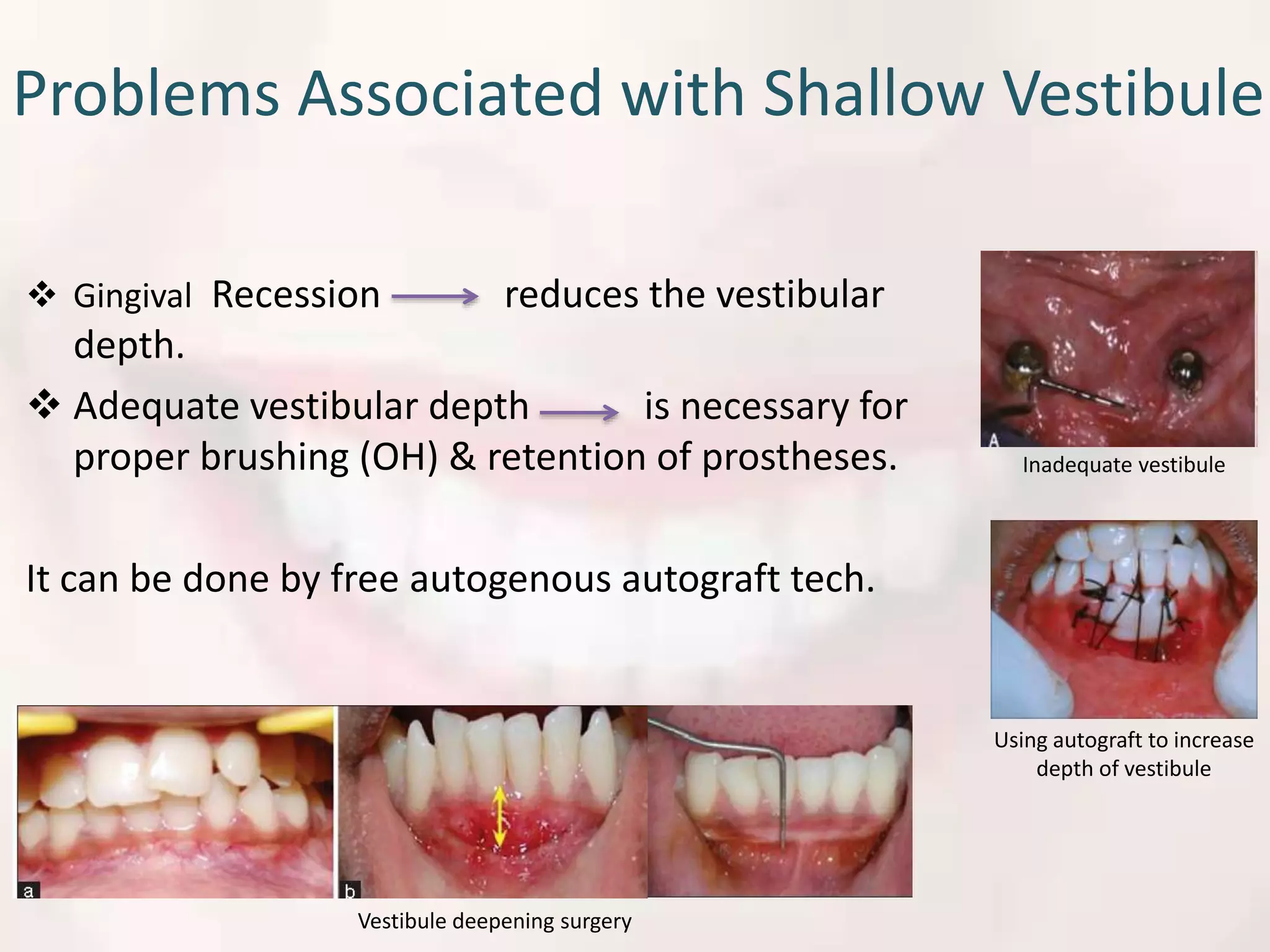 Periodontal plastic and esthetic surgery | PPTX