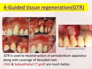 Periodontal plastic and esthetic surgery | PPTX