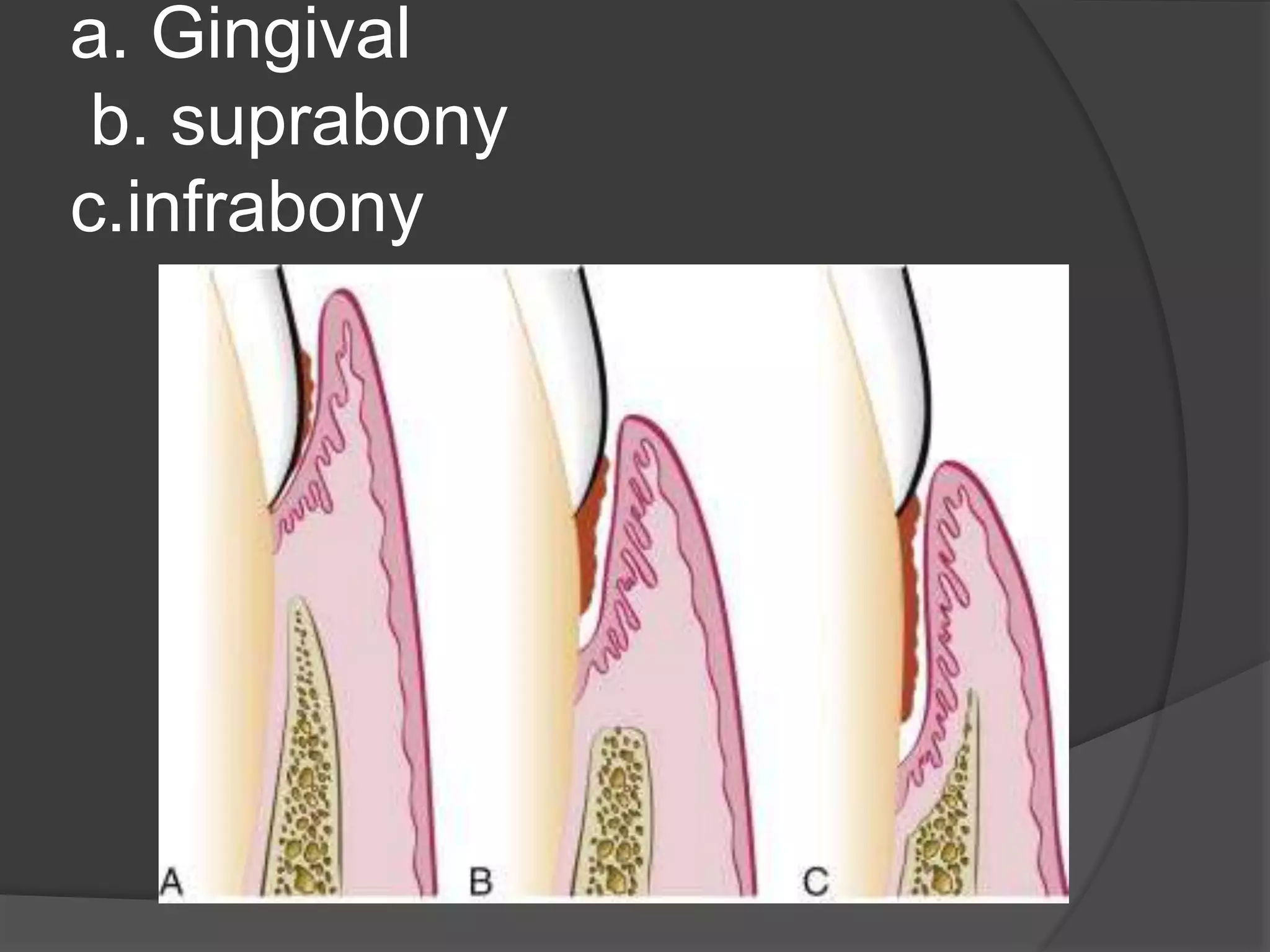 What Is A Suprabony Periodontal Pocket at George Hodge blog