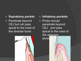 Periodontal pocket | PPTX