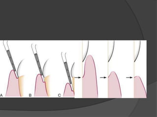 Periodontal pocket | PPTX