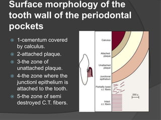 Periodontal pocket | PPT