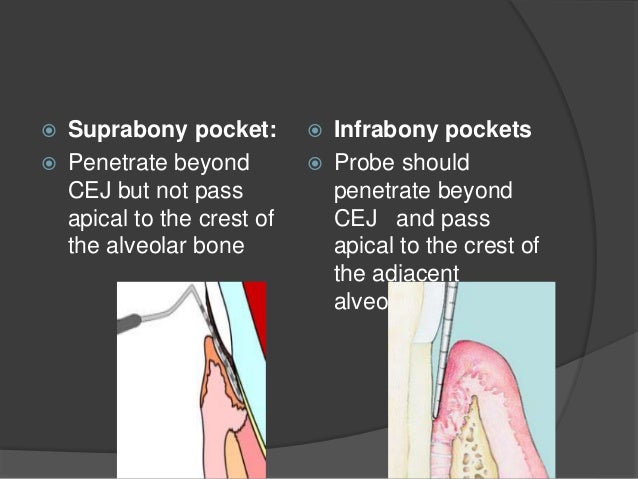 Periodontal pocket