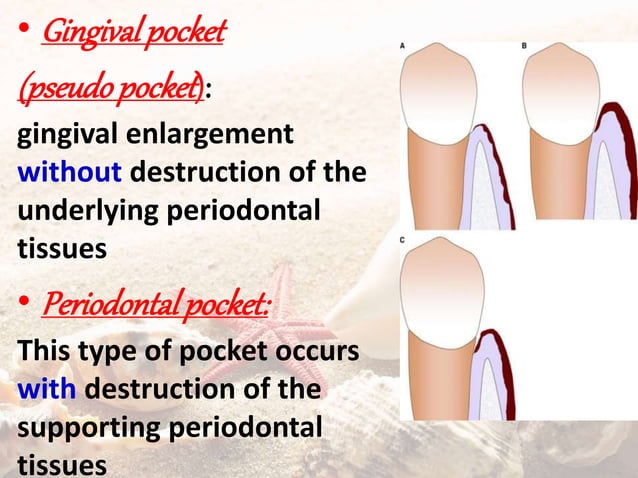 Periodontal pocket | PPTX