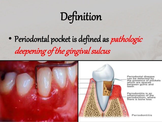 Periodontal pocket