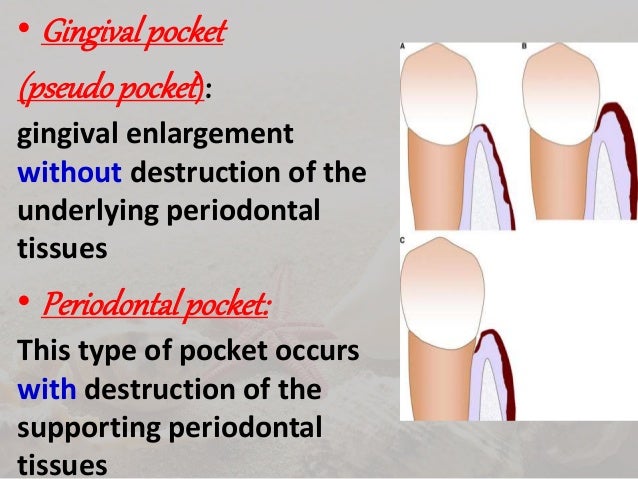 Periodontal pocket