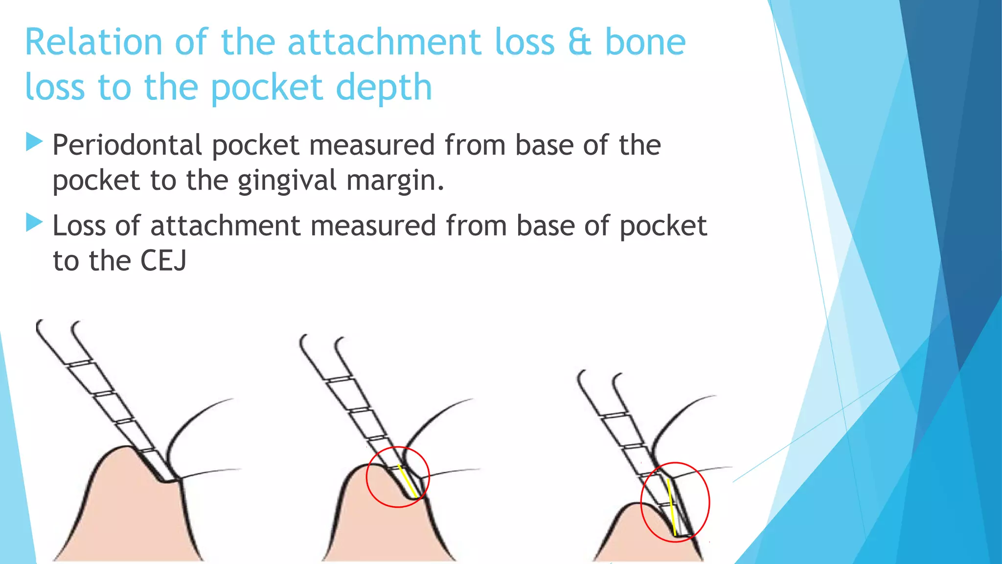 Periodontal pocket | PPT