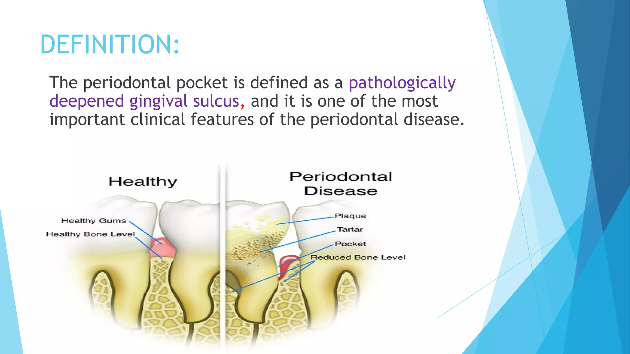 Periodontal pocket | PPT