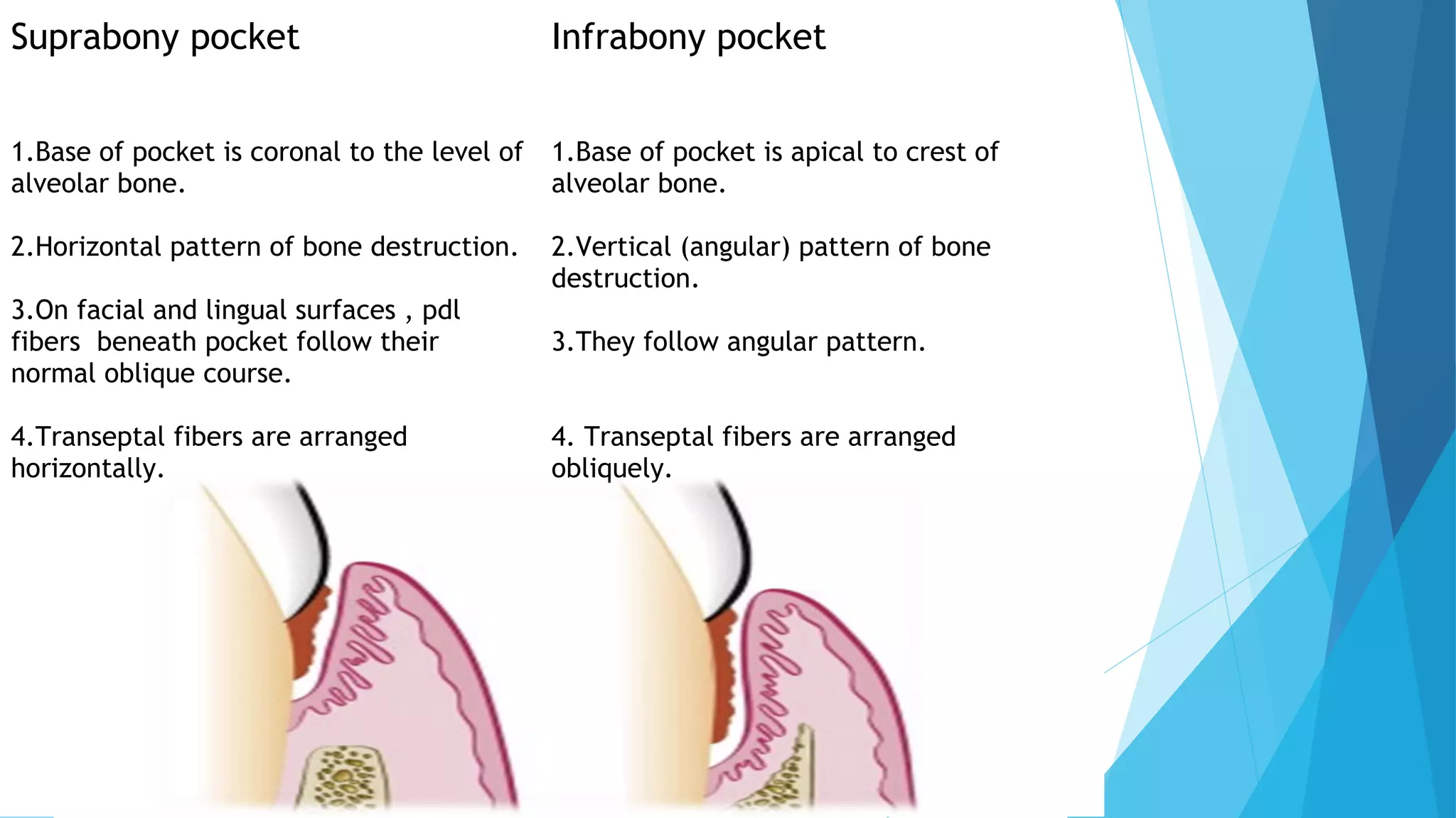 Periodontal pocket | PPT