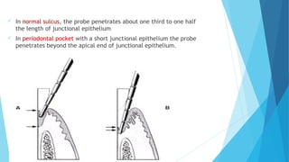Periodontal pocket | PPT | Free Download