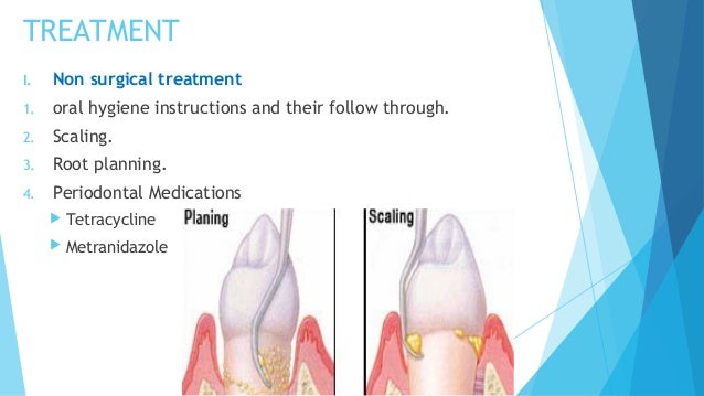 Periodontal pocket