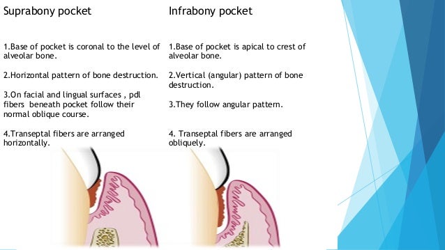 Periodontal pocket