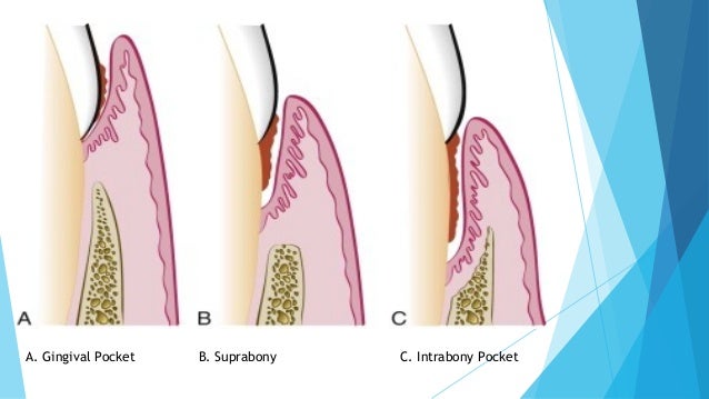 Periodontal pocket