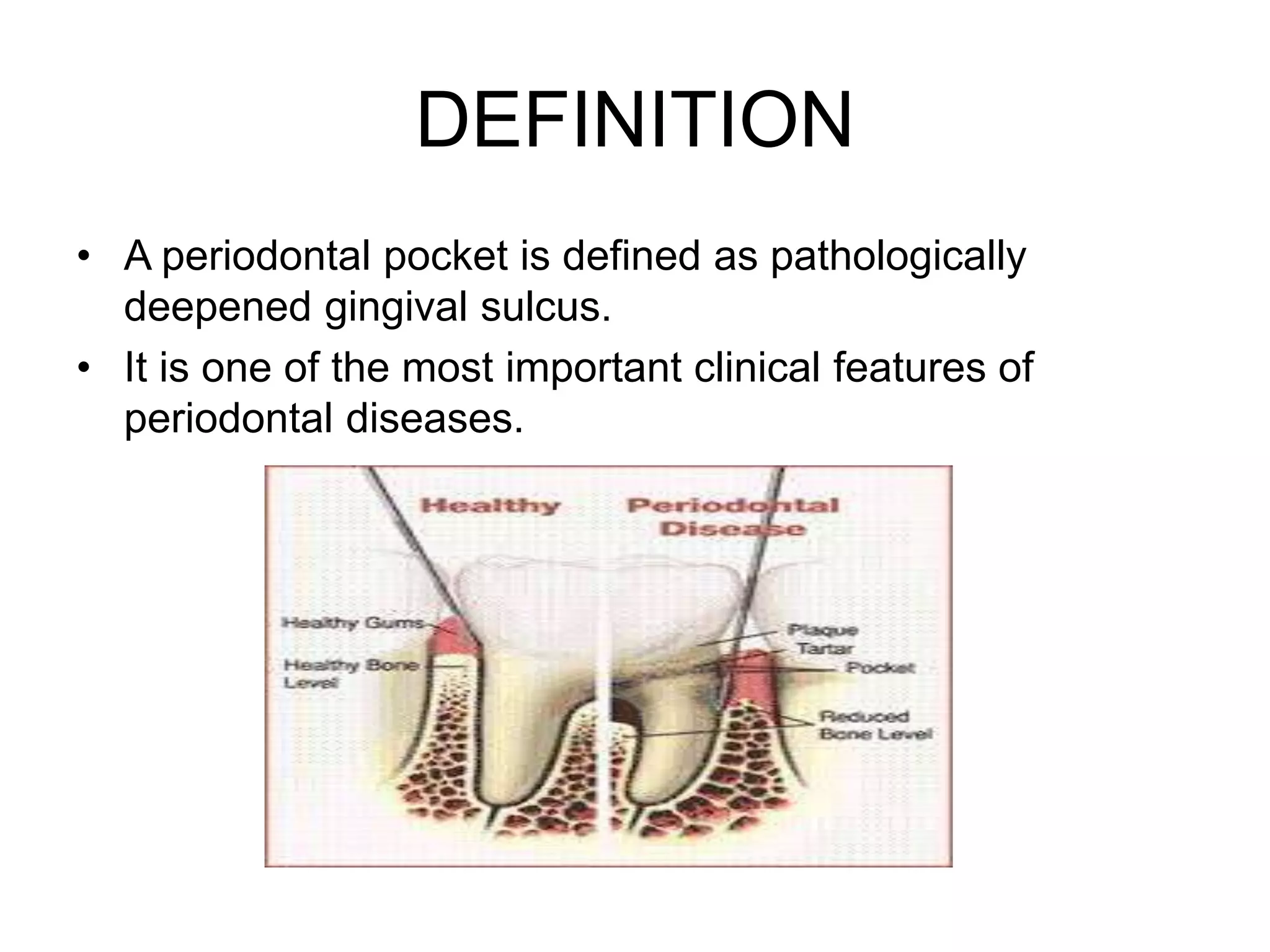PERIODONTAL_POCKET-16-12-14.ppt
