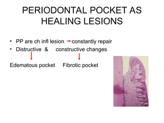 PERIODONTAL_POCKET- Pathogenesis and formation.ppt