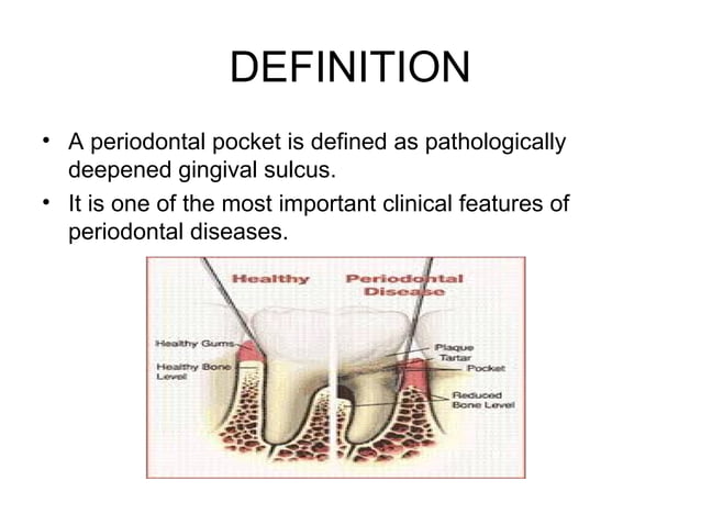 PERIODONTAL_POCKET- Pathogenesis and formation.ppt