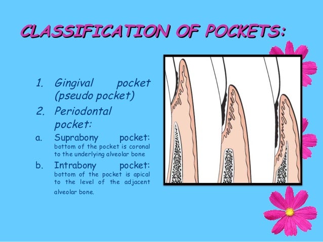Periodontal pocket