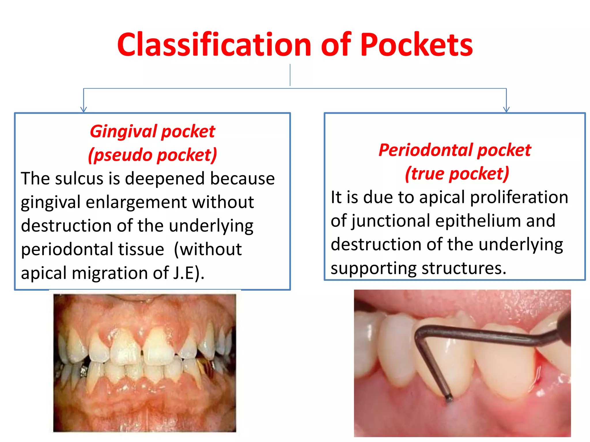 Periodontal pocket | PPTX