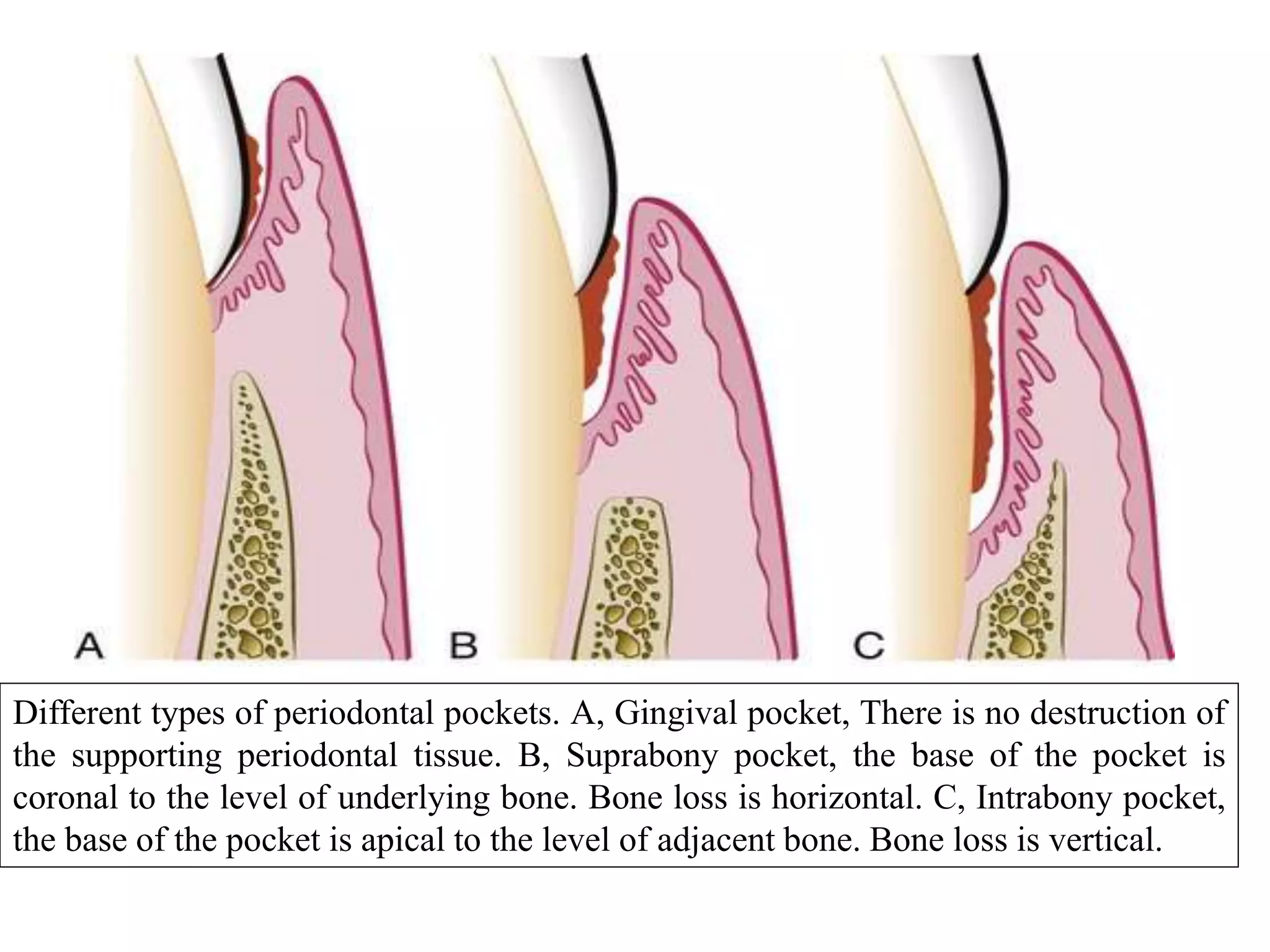 Periodontal pocket | PPTX