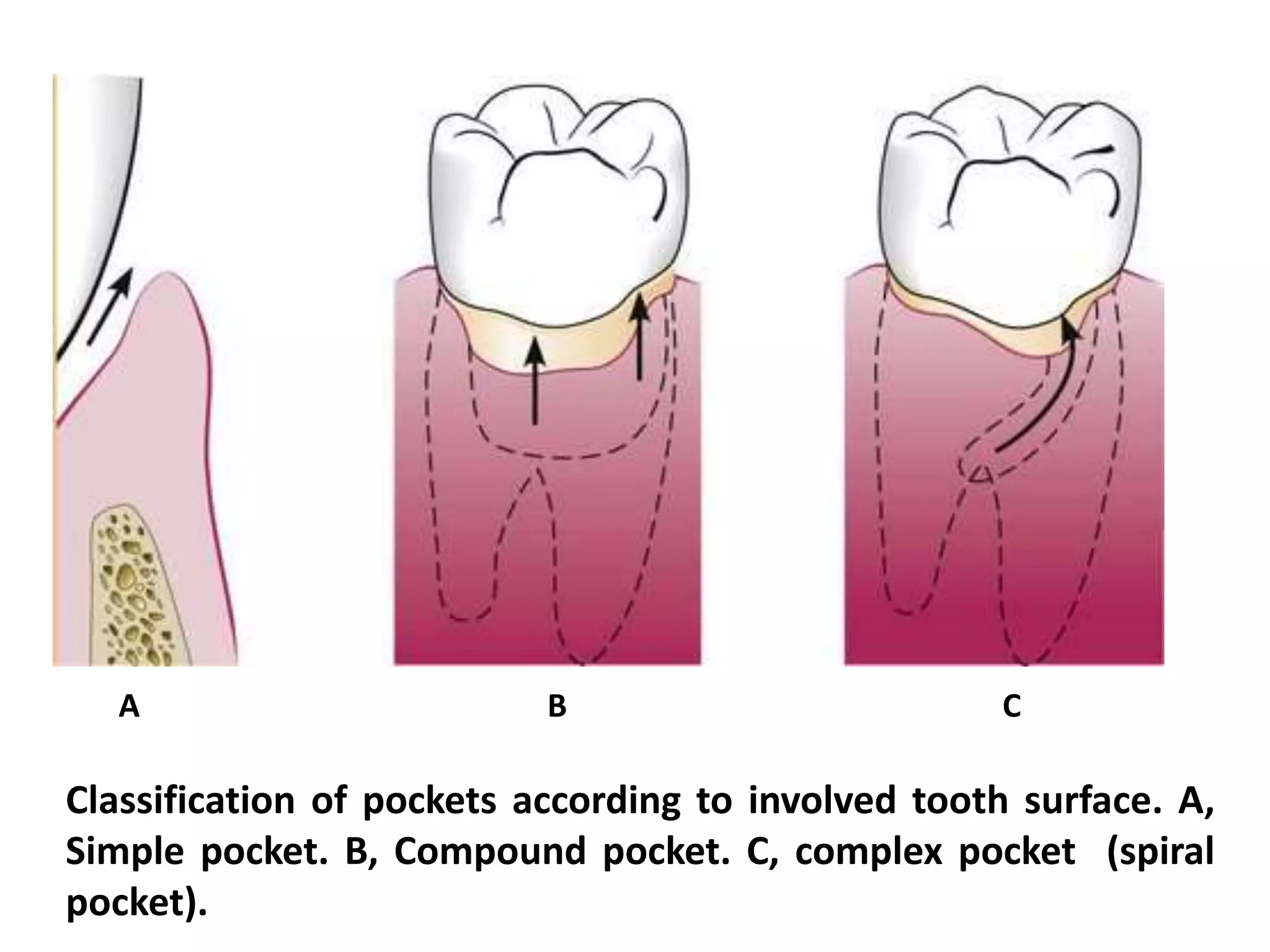Periodontal pocket | PPTX