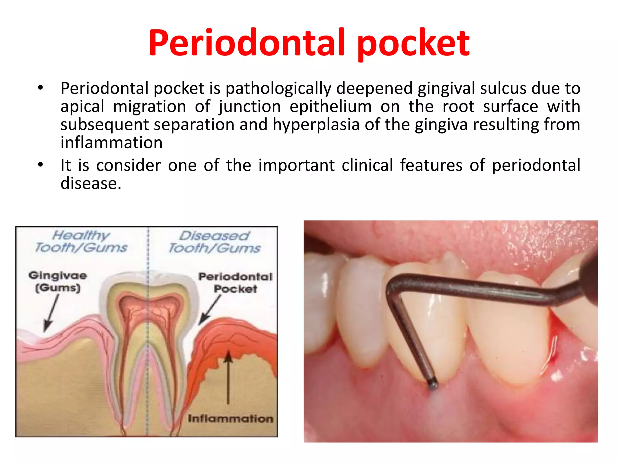 Periodontal pocket | PPTX