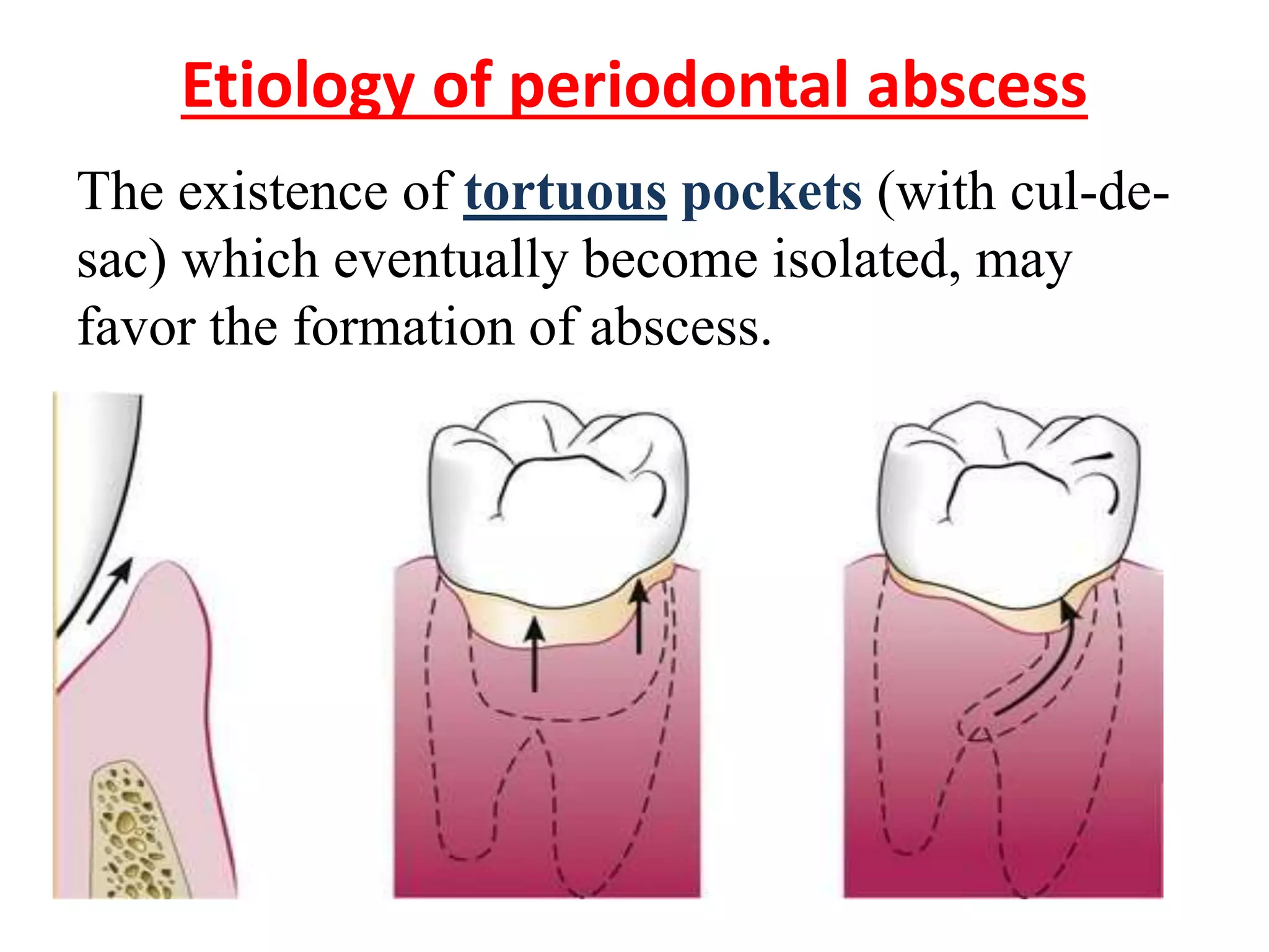 Periodontal pocket | PPTX