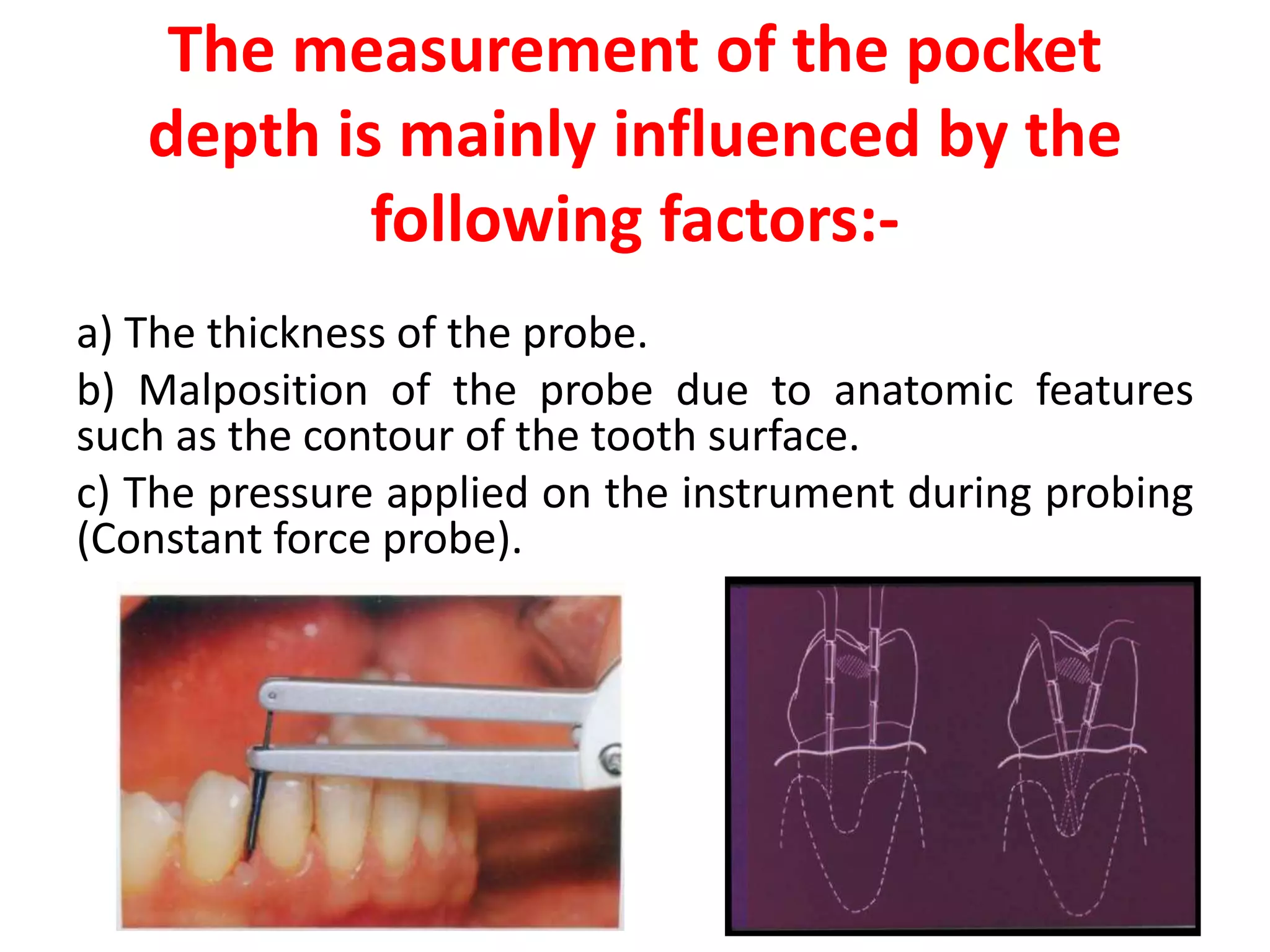 Periodontal pocket | PPTX