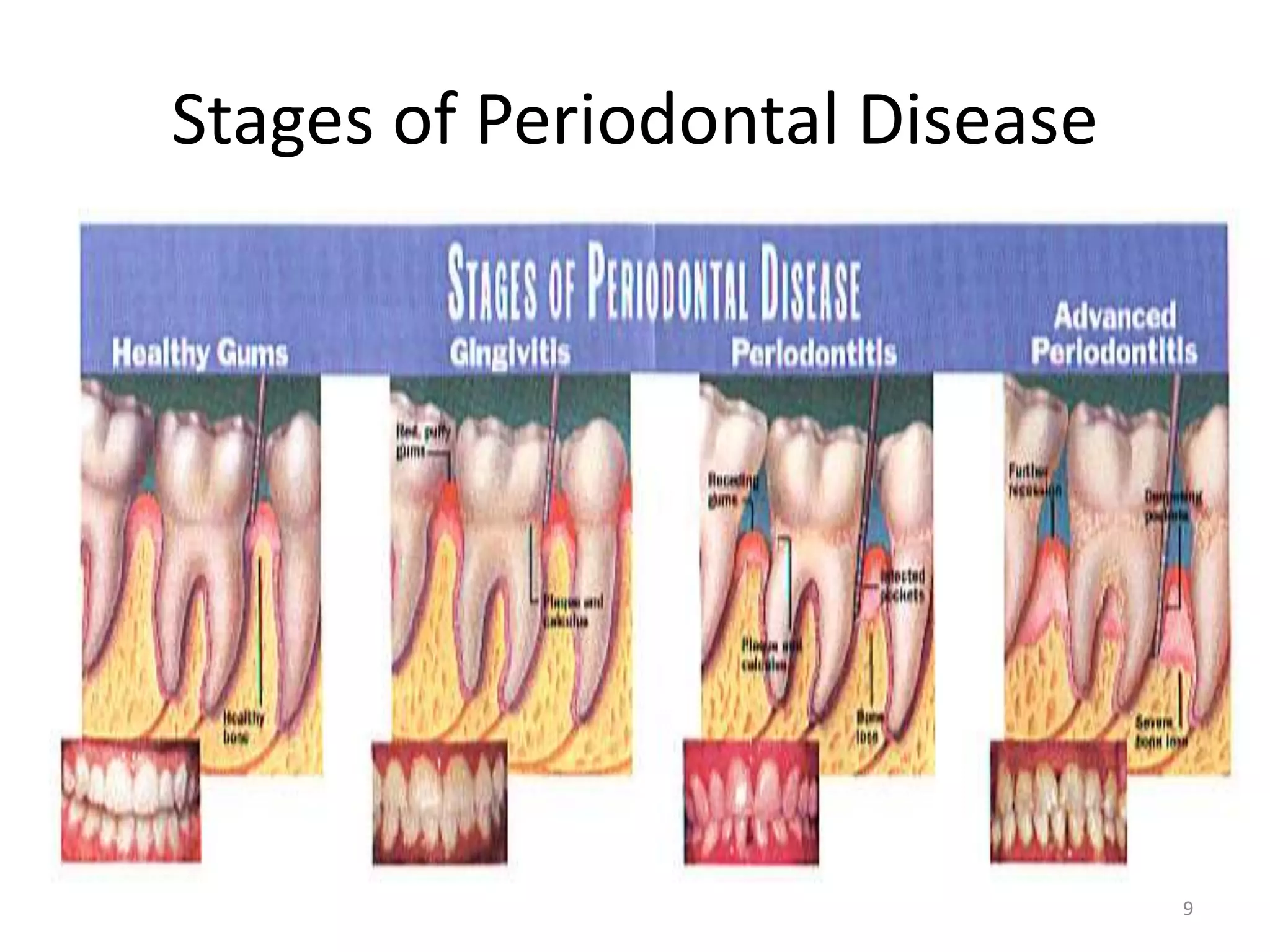 Periodontal pocket | PPTX
