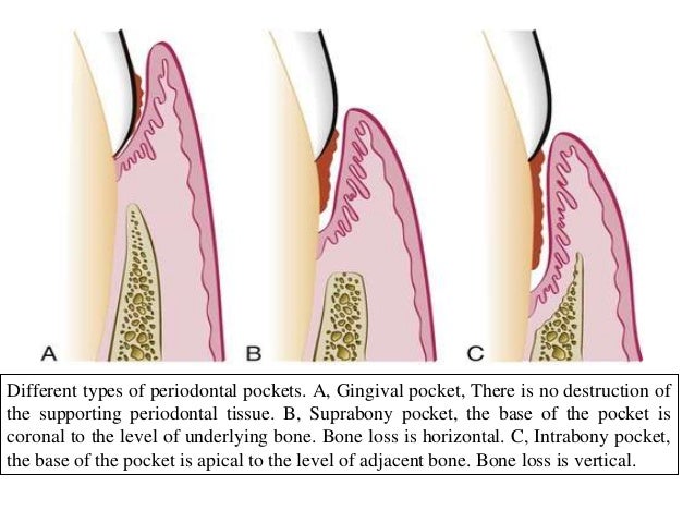 Periodontal pocket