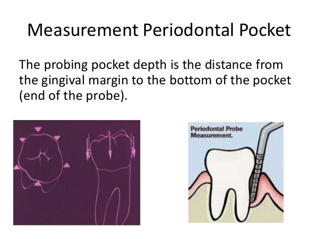 Periodontal pocket
