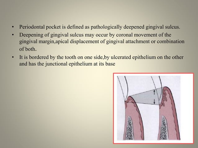 Periodontal pocket | PPTX