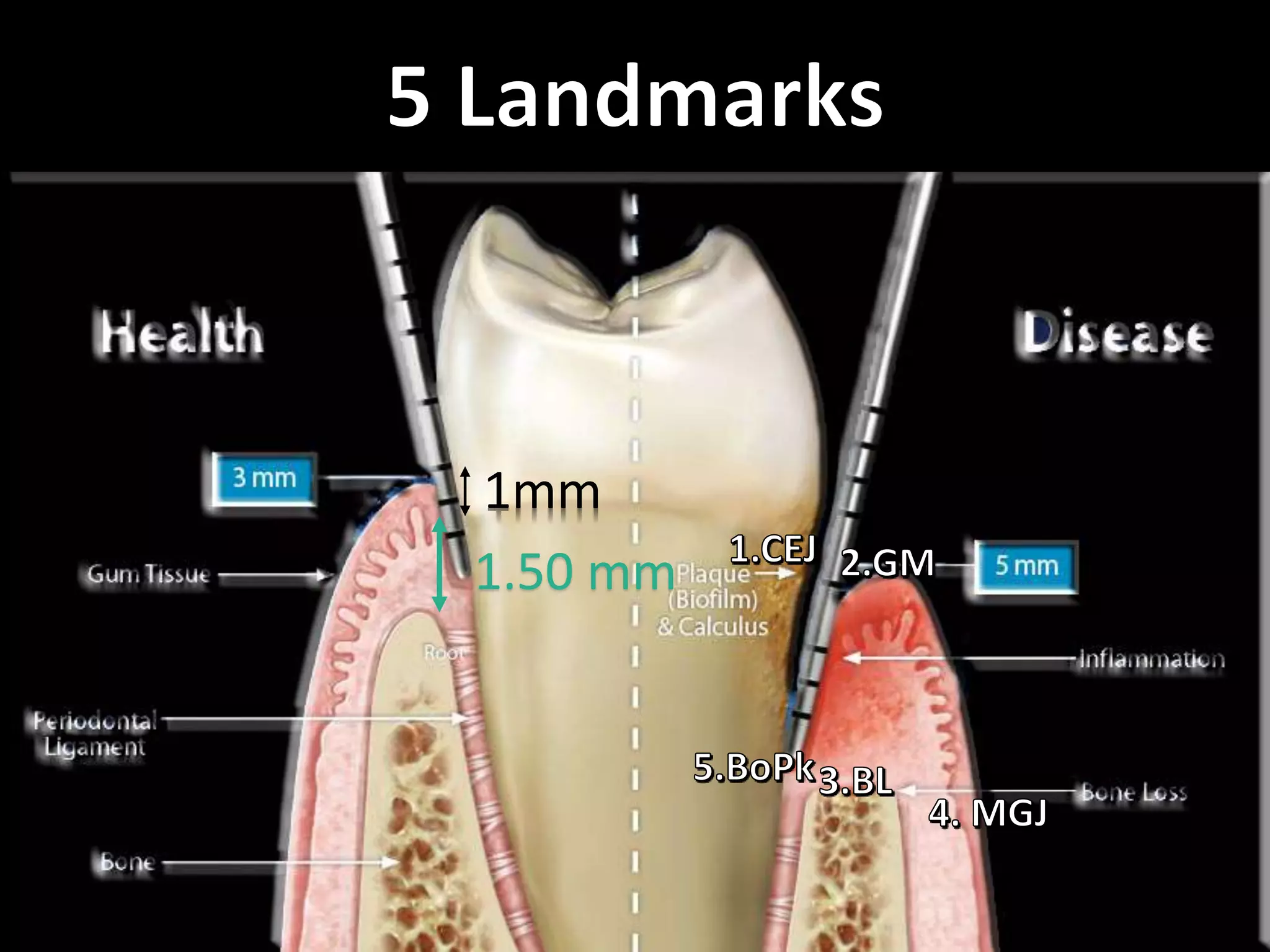 Periodontal pocket | PPTX