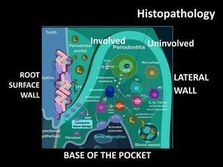 Periodontal pocket | PPTX