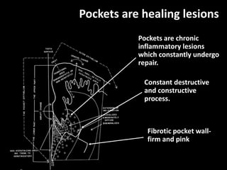 Periodontal pocket | PPTX