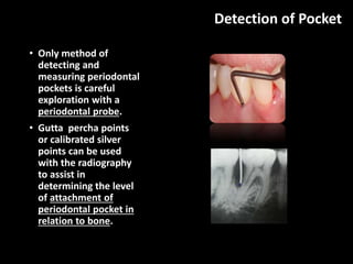 Periodontal pocket | PPTX