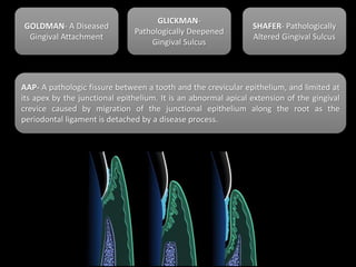 Periodontal pocket | PPTX