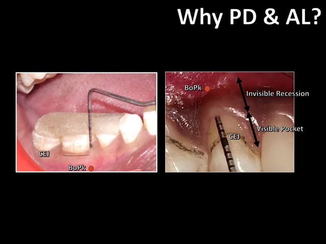 Periodontal pocket | PPTX