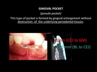 Periodontal pocket | PPTX