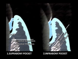 Periodontal pocket | PPTX