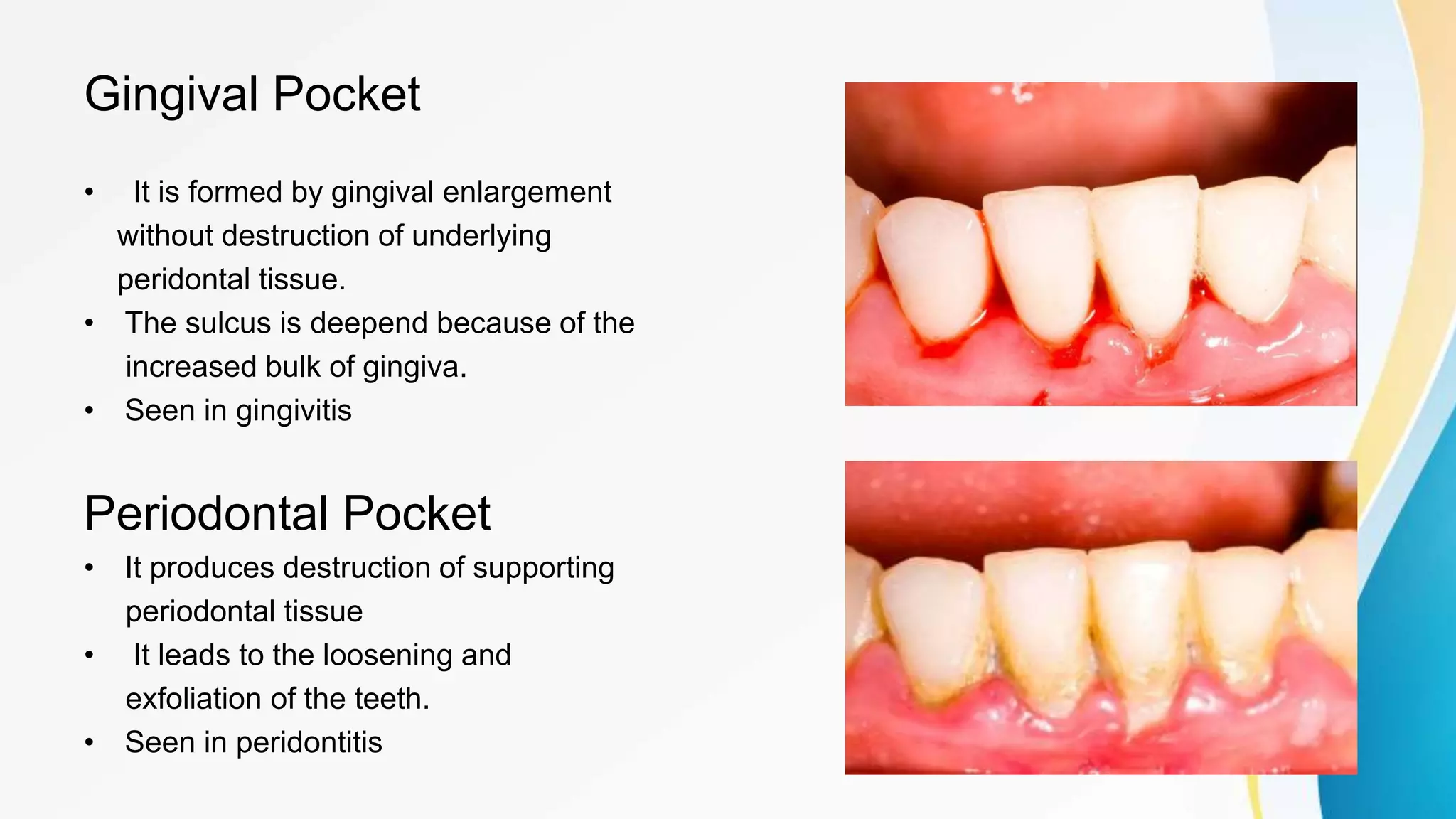 Periodontal pocket , Gingival Recession , Tooth mobility | PPTX