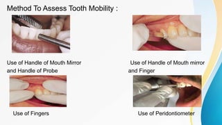 Periodontal pocket , Gingival Recession , Tooth mobility | PPTX
