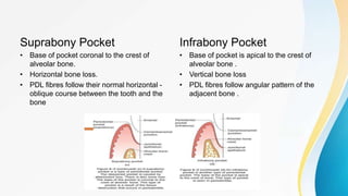 Periodontal pocket , Gingival Recession , Tooth mobility | PPTX
