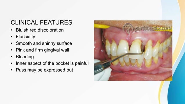 Periodontal pocket , Gingival Recession , Tooth mobility | PPTX | Oral ...