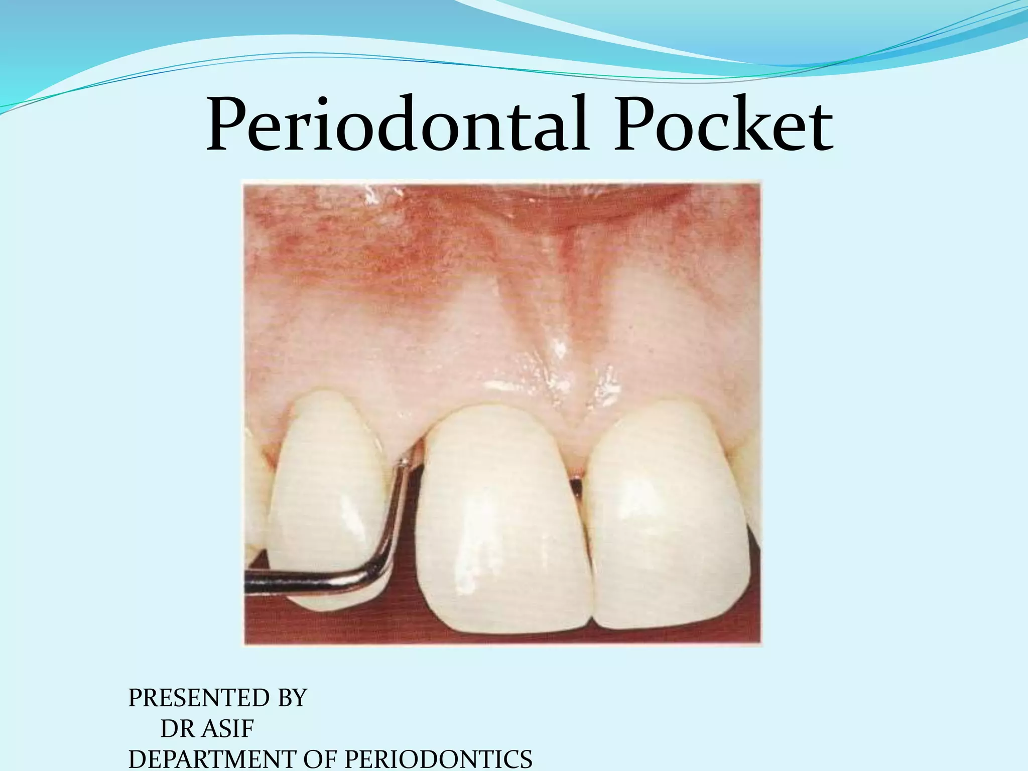 Periodontal Pocket.pptx