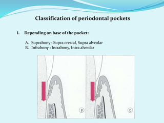 Periodontal Pocket.pptx